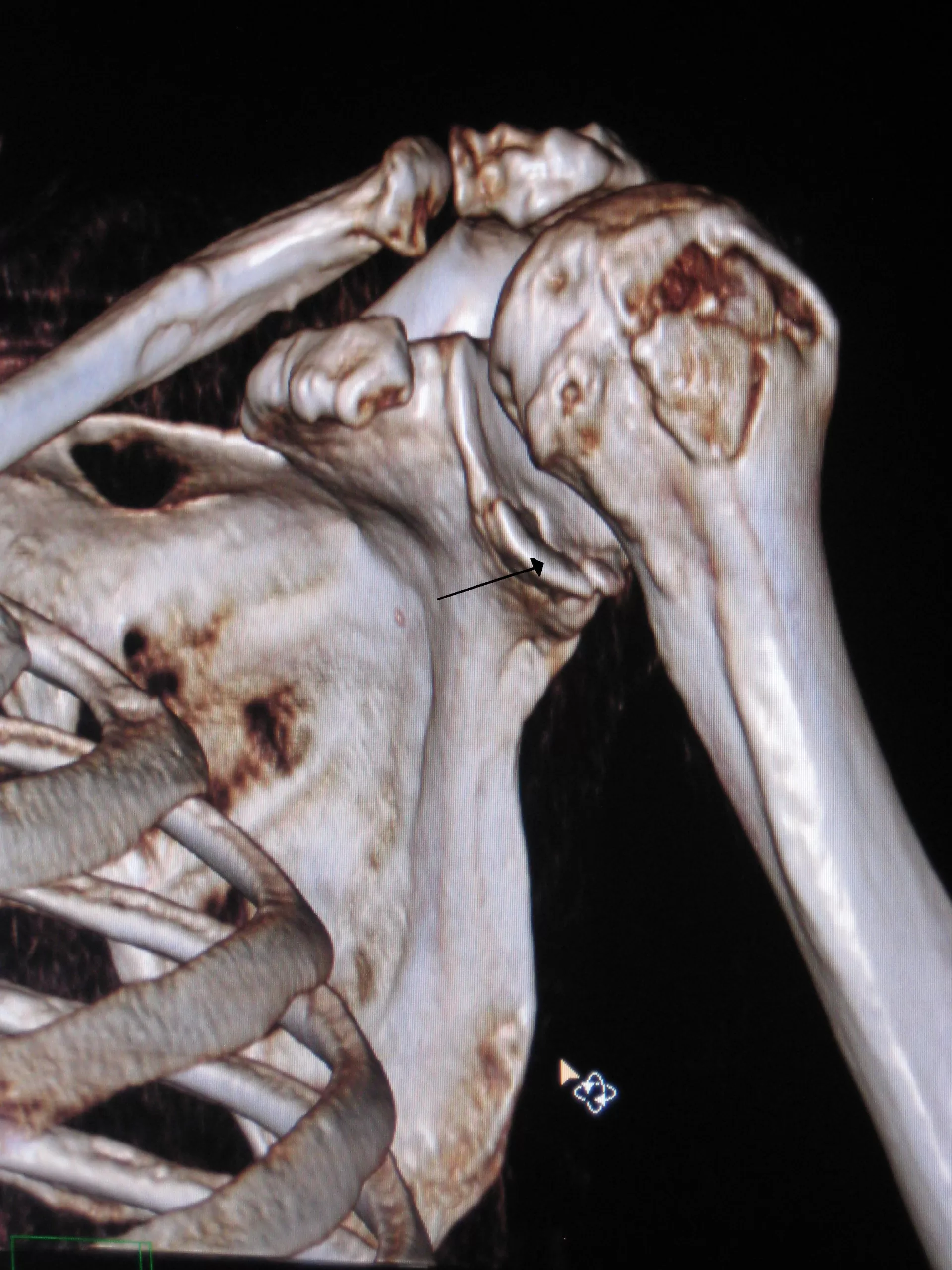 Shoulder Stabilisation and Bankart Repair: Your Path Back to Sport ...